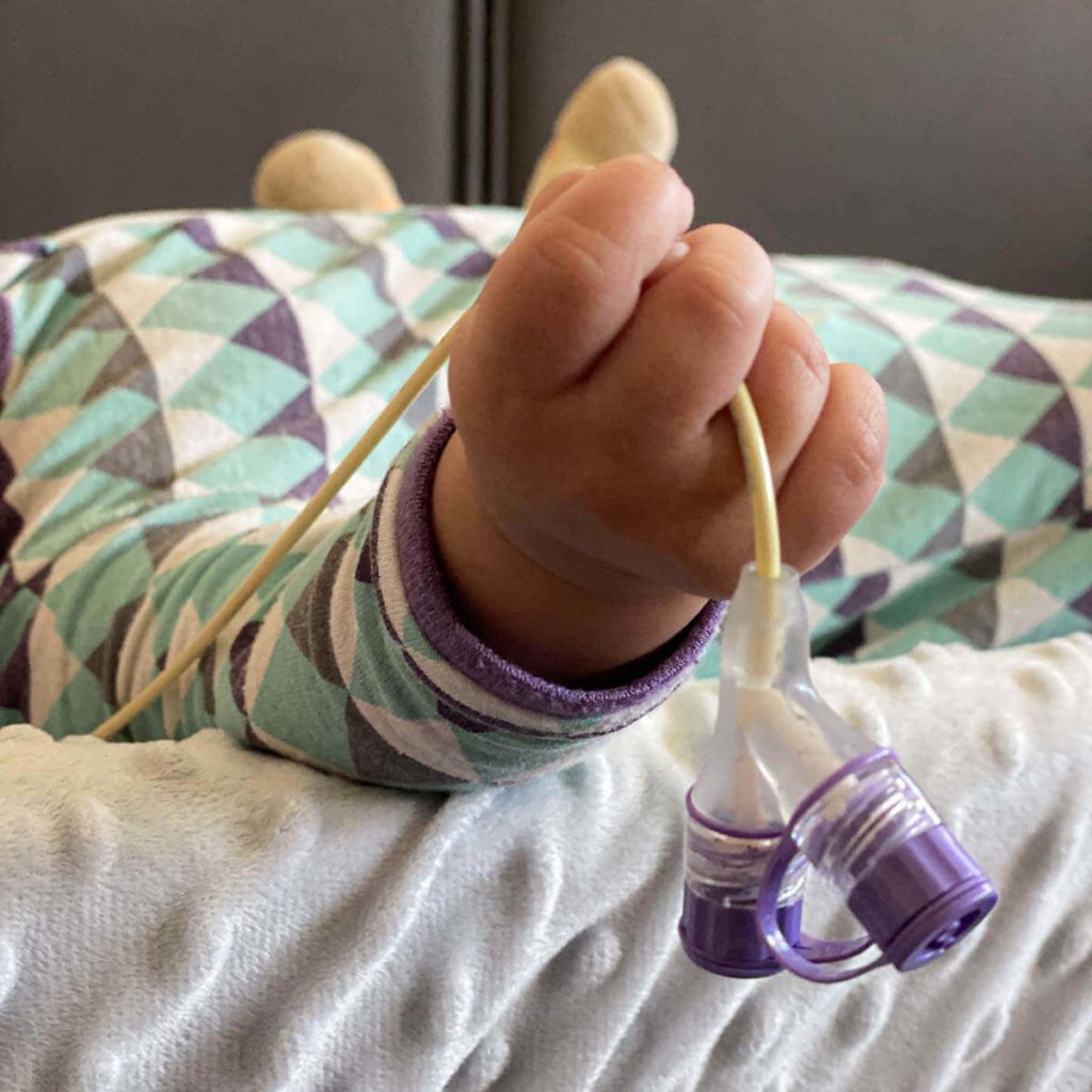 How to Tape NG Tube: The Best Way on a Baby