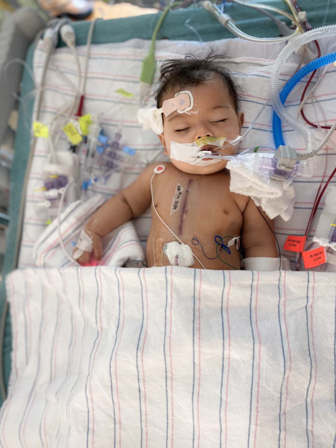 Lines and Tubes and Beeps, oh My!: A Baby After Open Heart Surgery