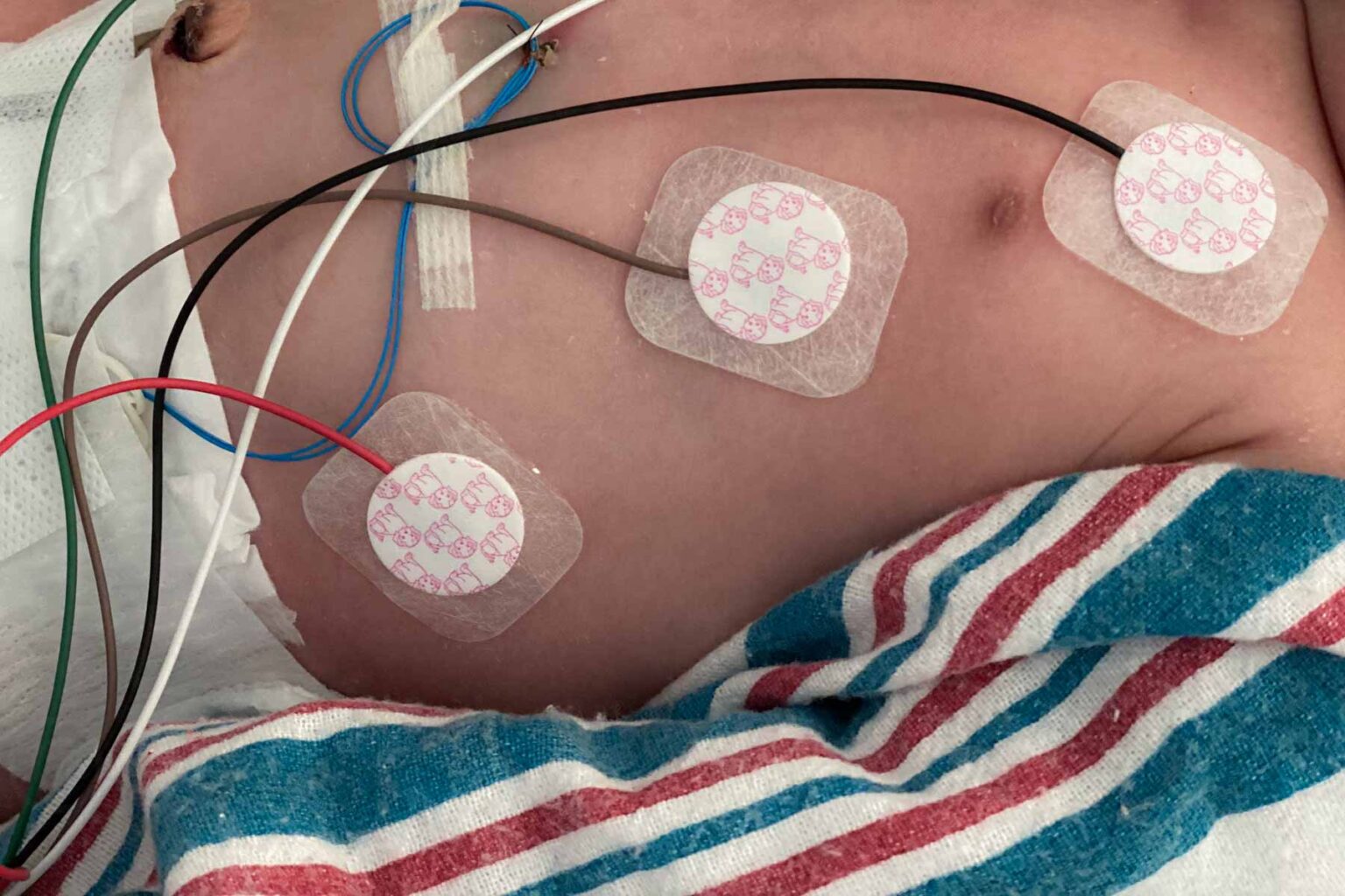 Lines and Tubes and Beeps, oh My!: A Baby After Open Heart Surgery