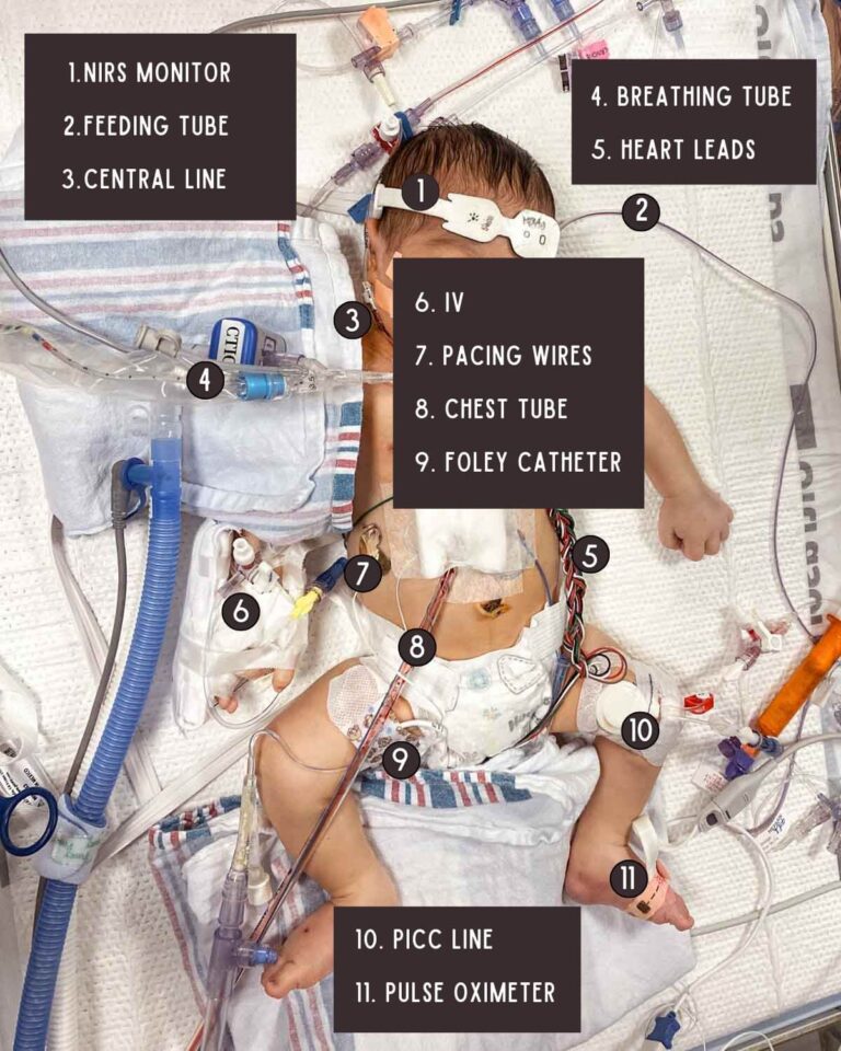 Lines and Tubes and Beeps, oh My!: A Baby After Open Heart Surgery