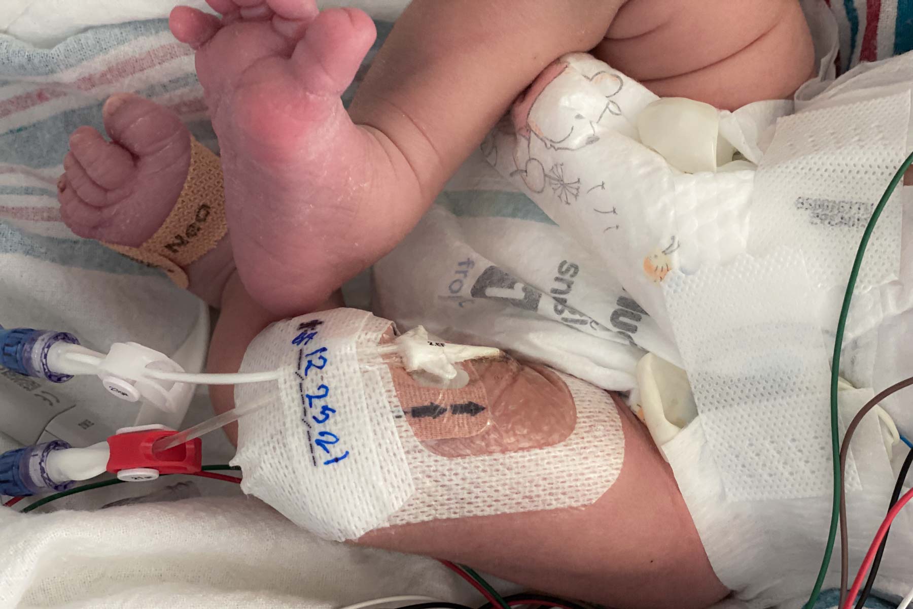 Lines and Tubes and Beeps, oh My!: A Baby After Open Heart Surgery